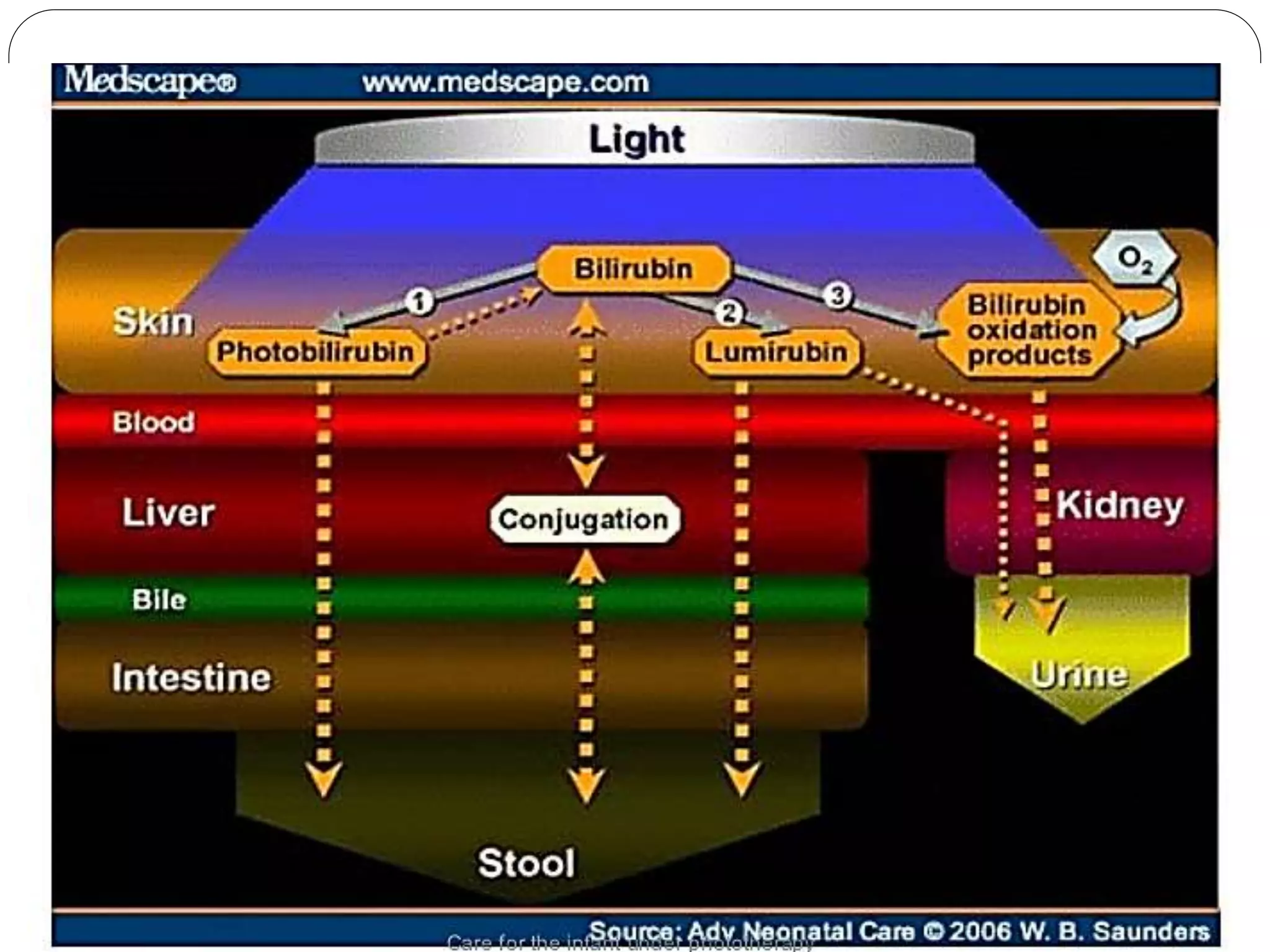 Phototherapy in neonatal jaundice | PPTX