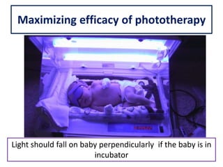 Phototherapy in jaundice | PPTX