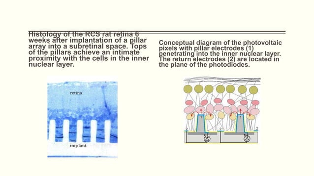 Photovoltaic retinal prosthesis for restoring sight to the blind | PPTX | Eye and Vision ...