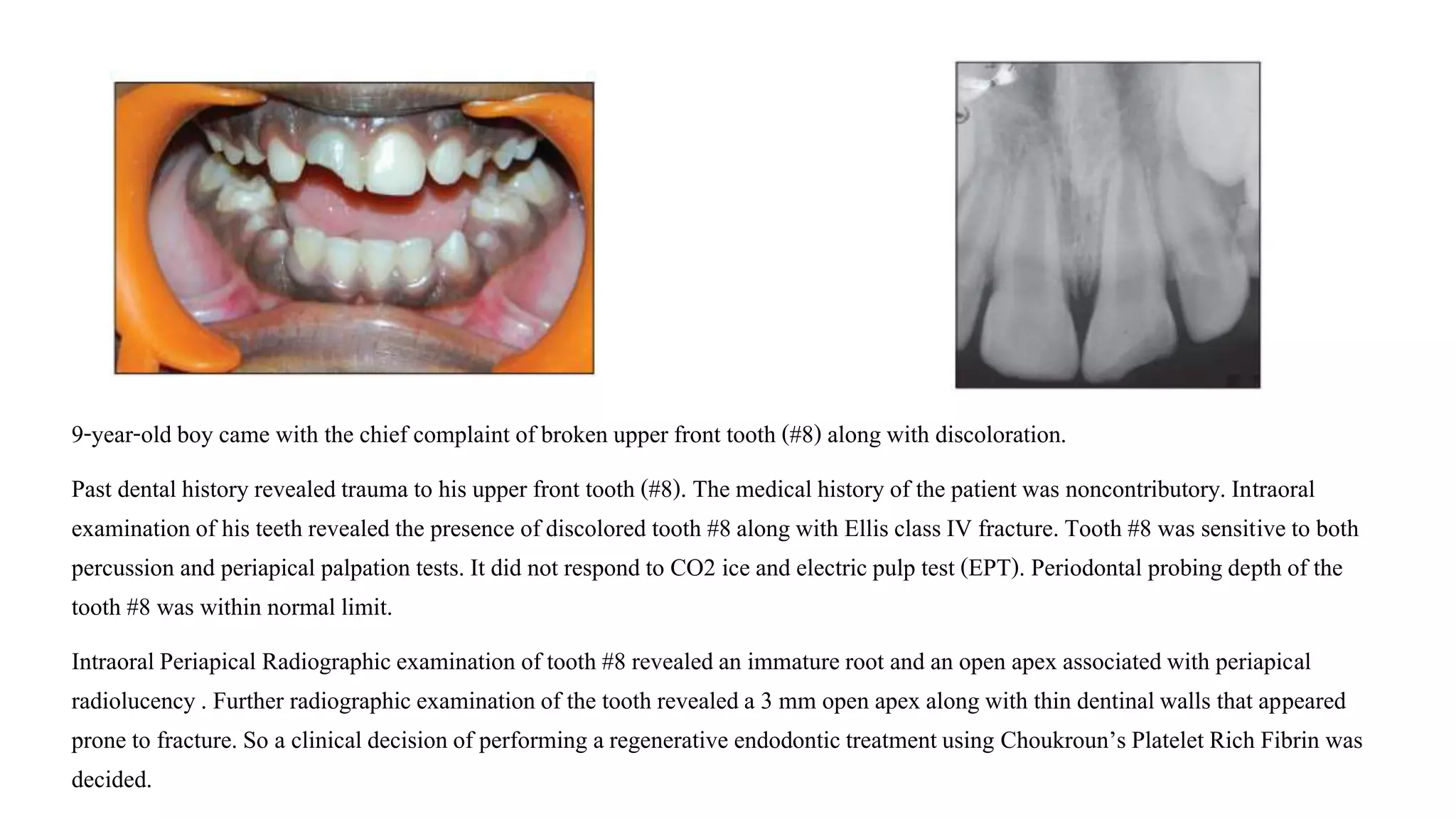 PERIAPICAL WOUND HEALING | PPTX