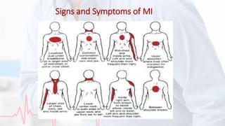 Myocardial Infarction | PPTX