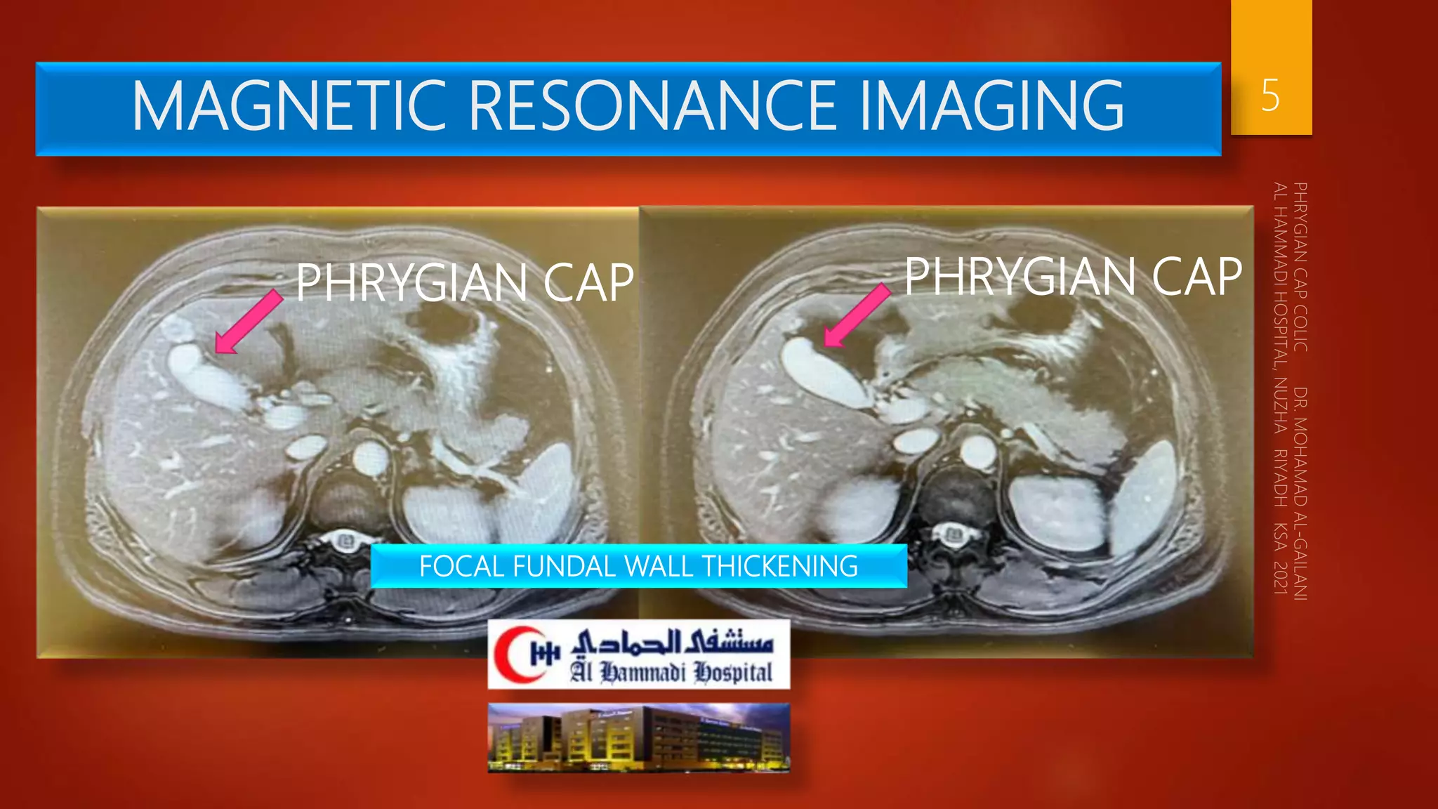 Phrygian Cap Colic | PPTX