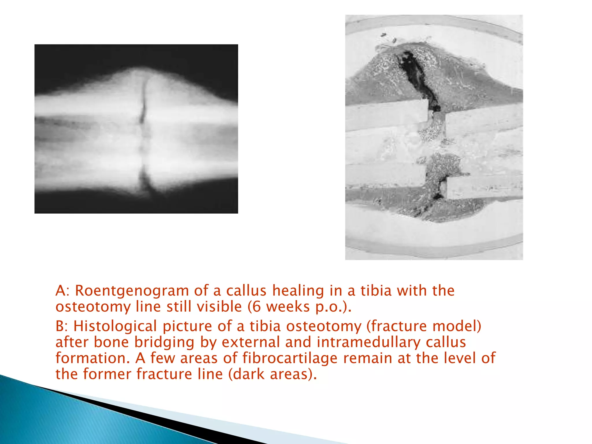 Phsiology of fractures | PPTX