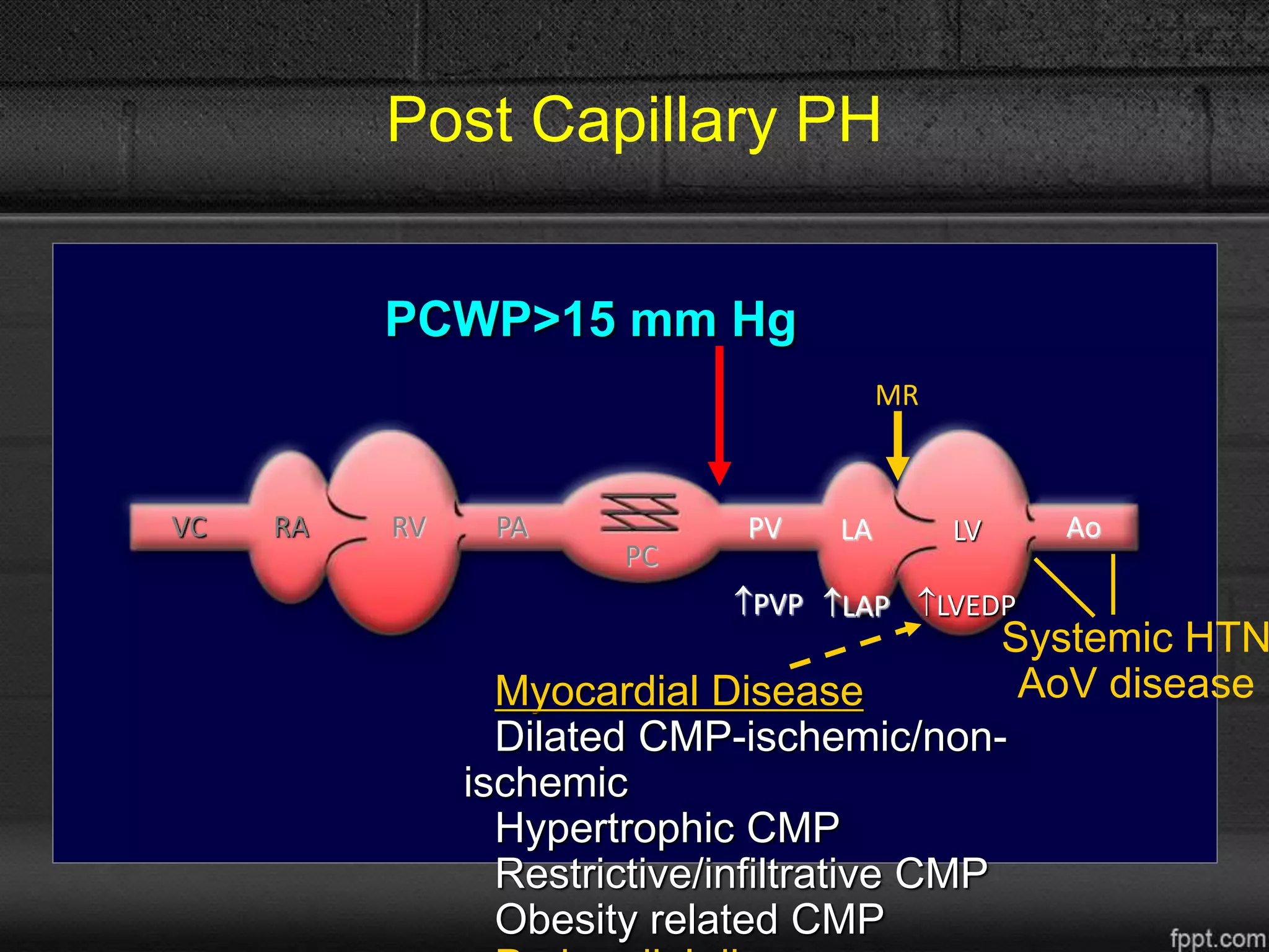 PULMONARY HYPERTENSION | PPT