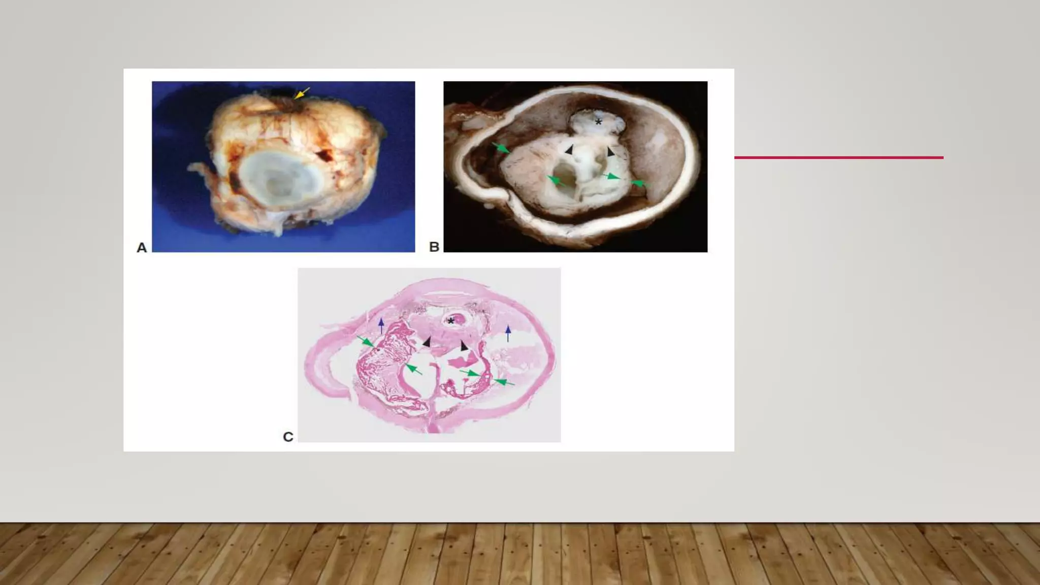 Phthisis bulbi..elias t | PPTX