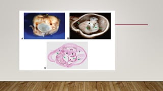 Phthisis bulbi..elias t | PPTX