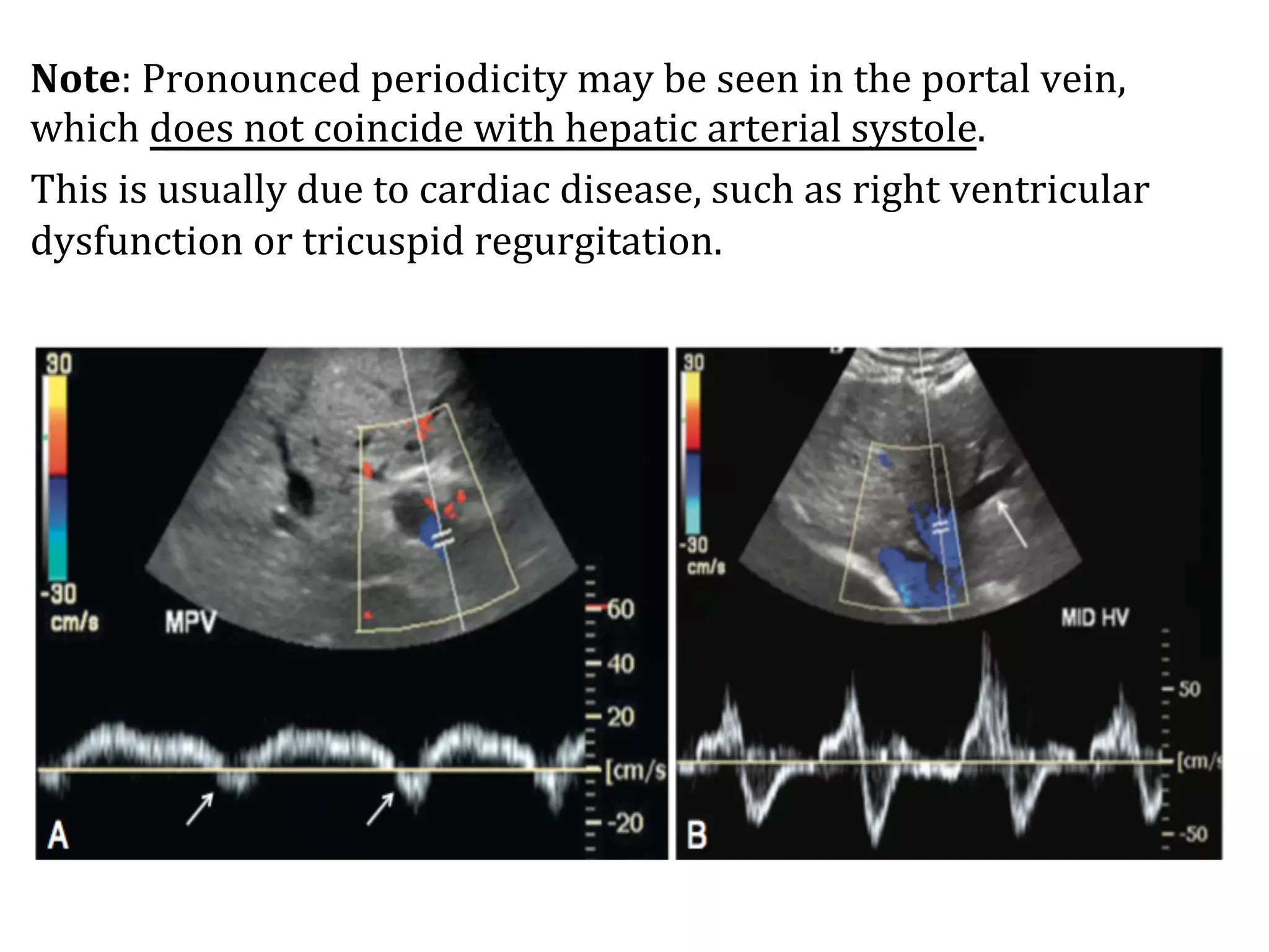 Portal hypertension : Role of USG & CT Portography by Dr. Anil Jangir | PDF