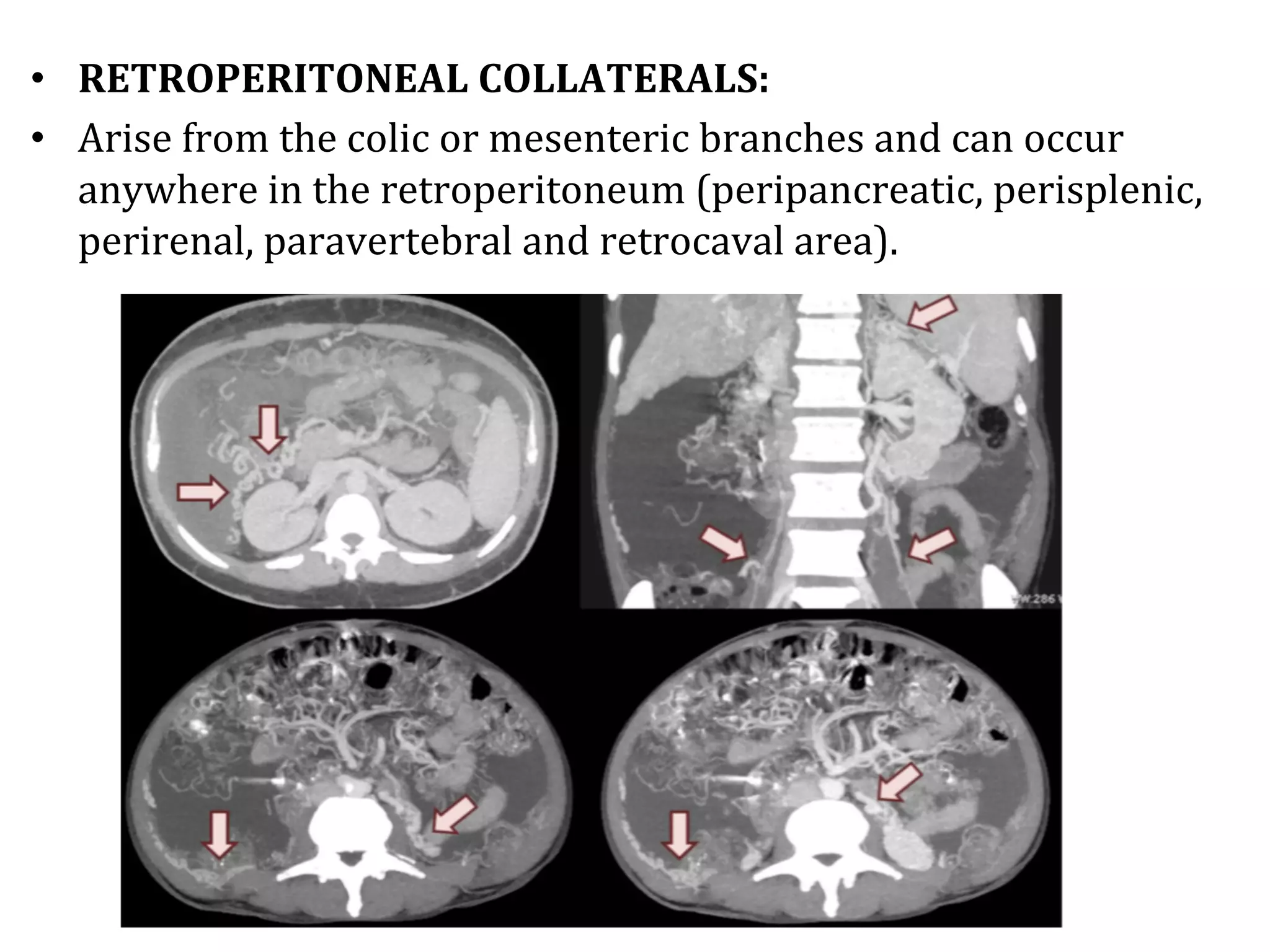 Portal hypertension : Role of USG & CT Portography by Dr. Anil Jangir | PDF