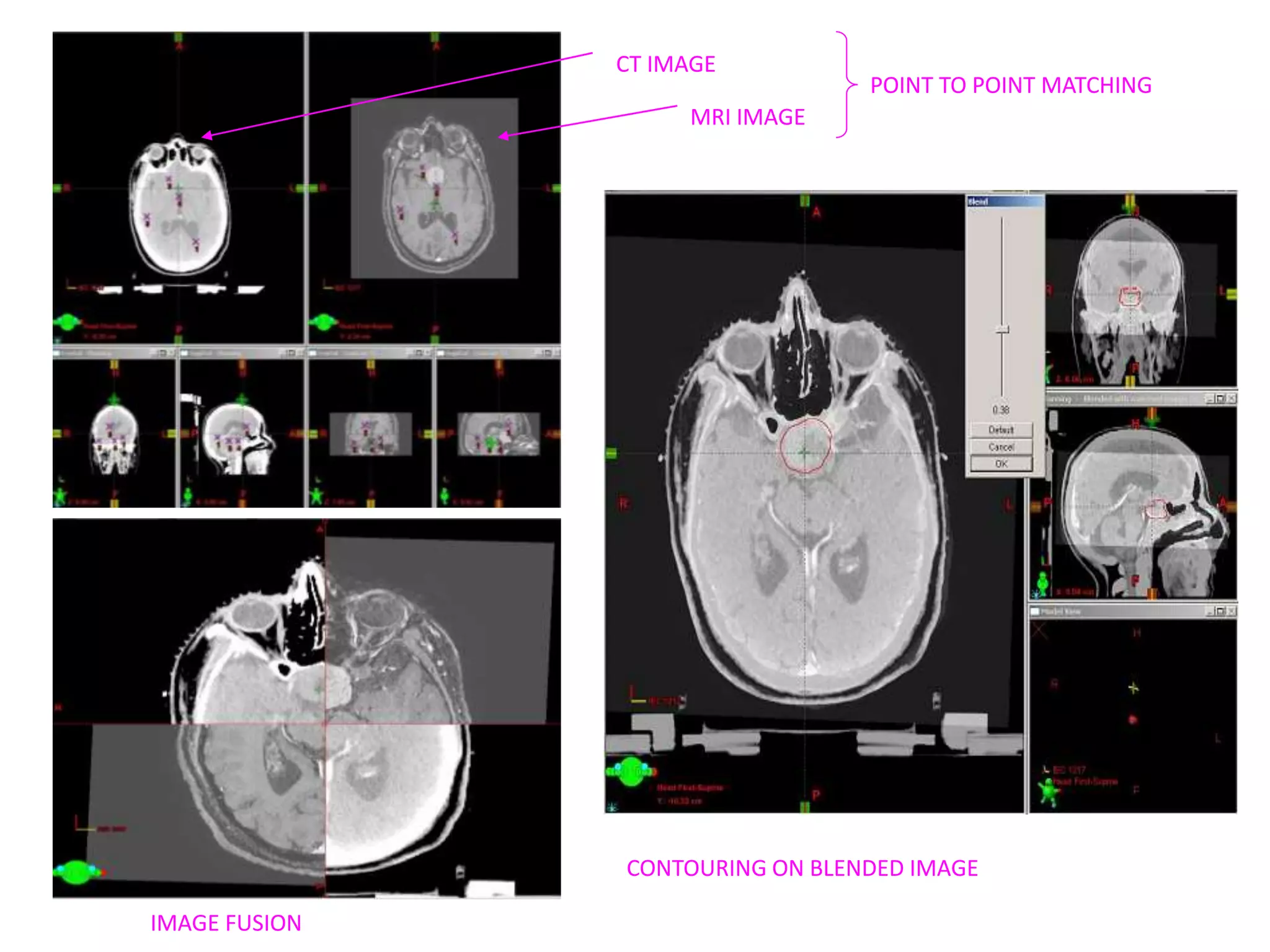Three dimensional conformal radiotherapy - 3D-CRT and IMRT - Intensity ...