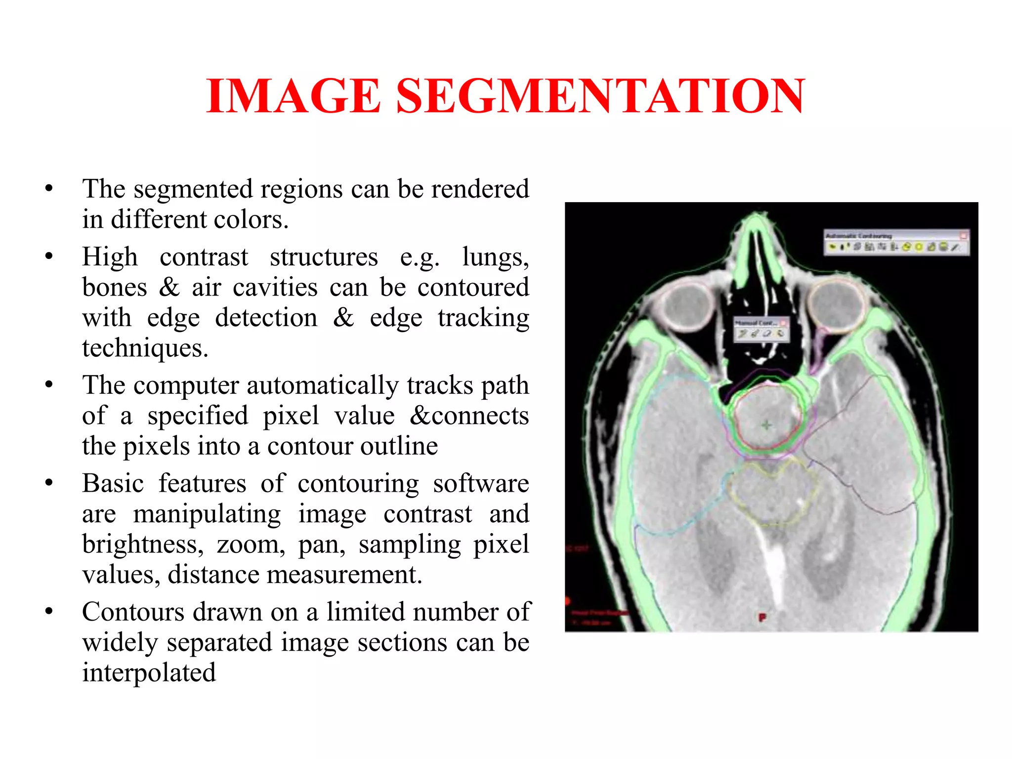 Three dimensional conformal radiotherapy - 3D-CRT and IMRT - Intensity ...