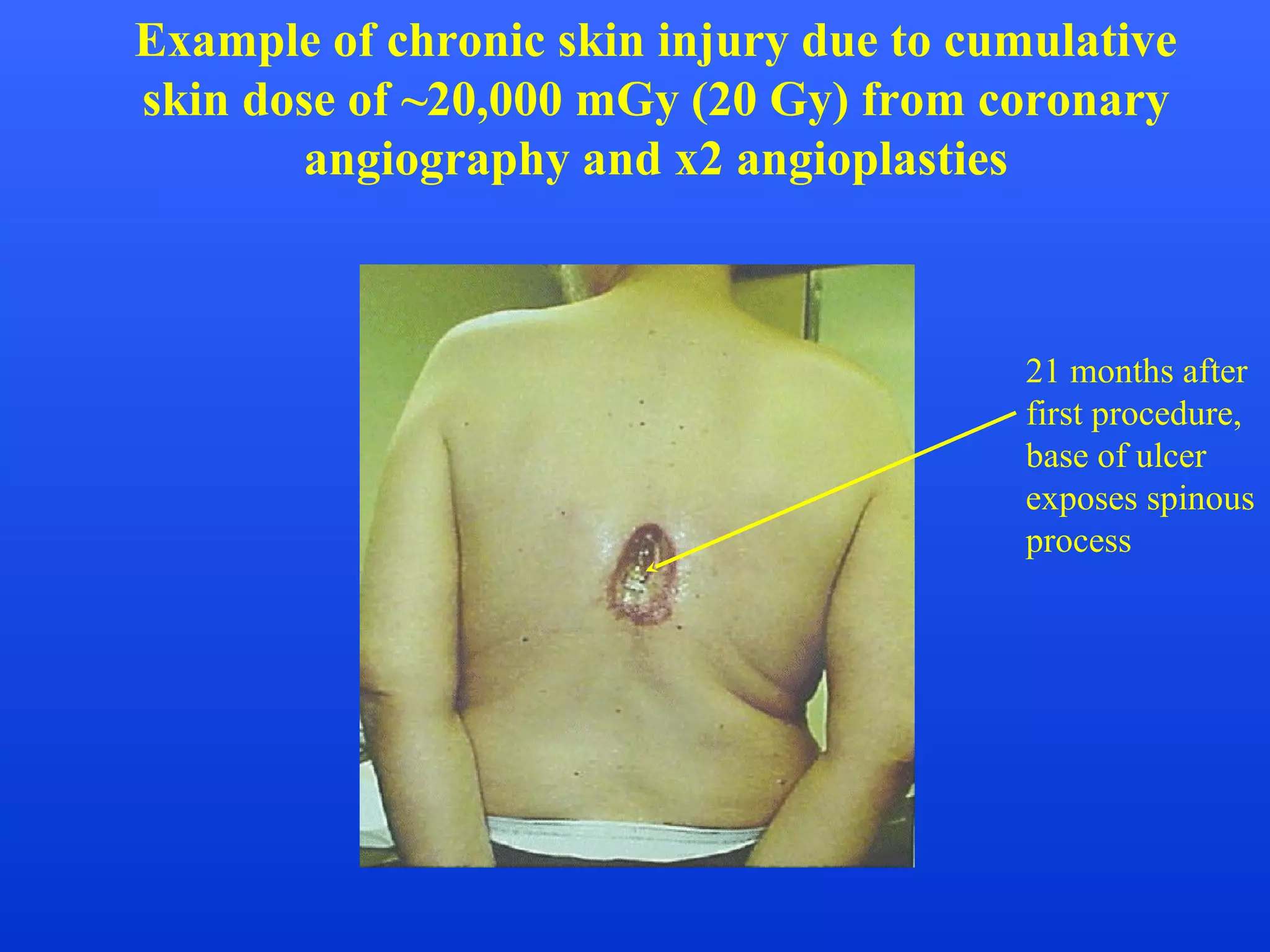 ICRP 85 avoiding radiation injury | PPT