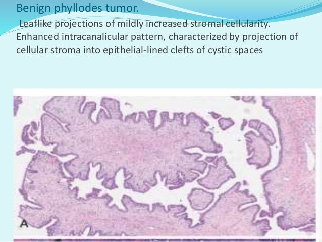 Phyllodes Tumour