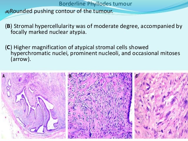 Phyllodes Tumour