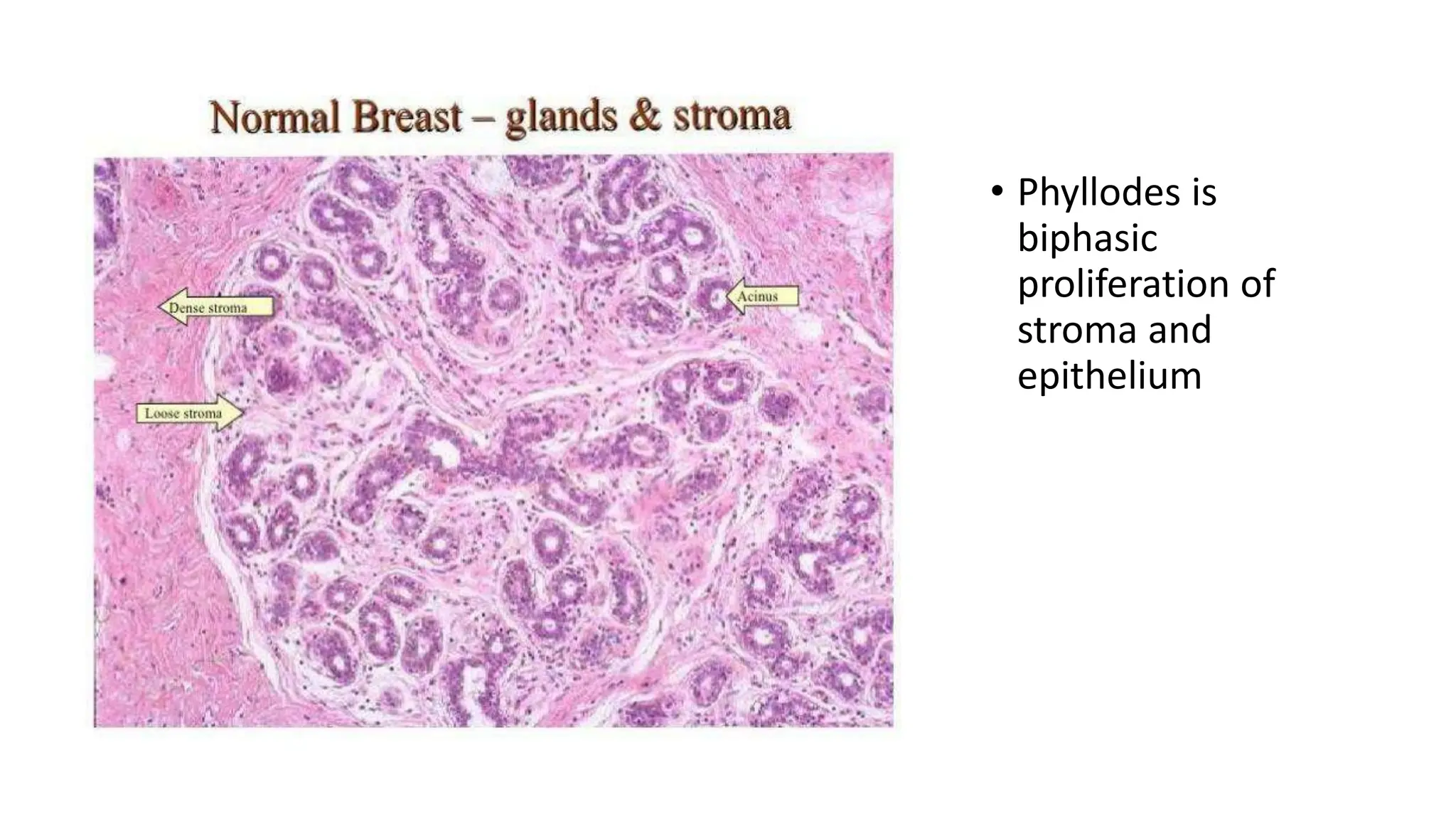 phyllodes tumour final presentation of breast | PPTX