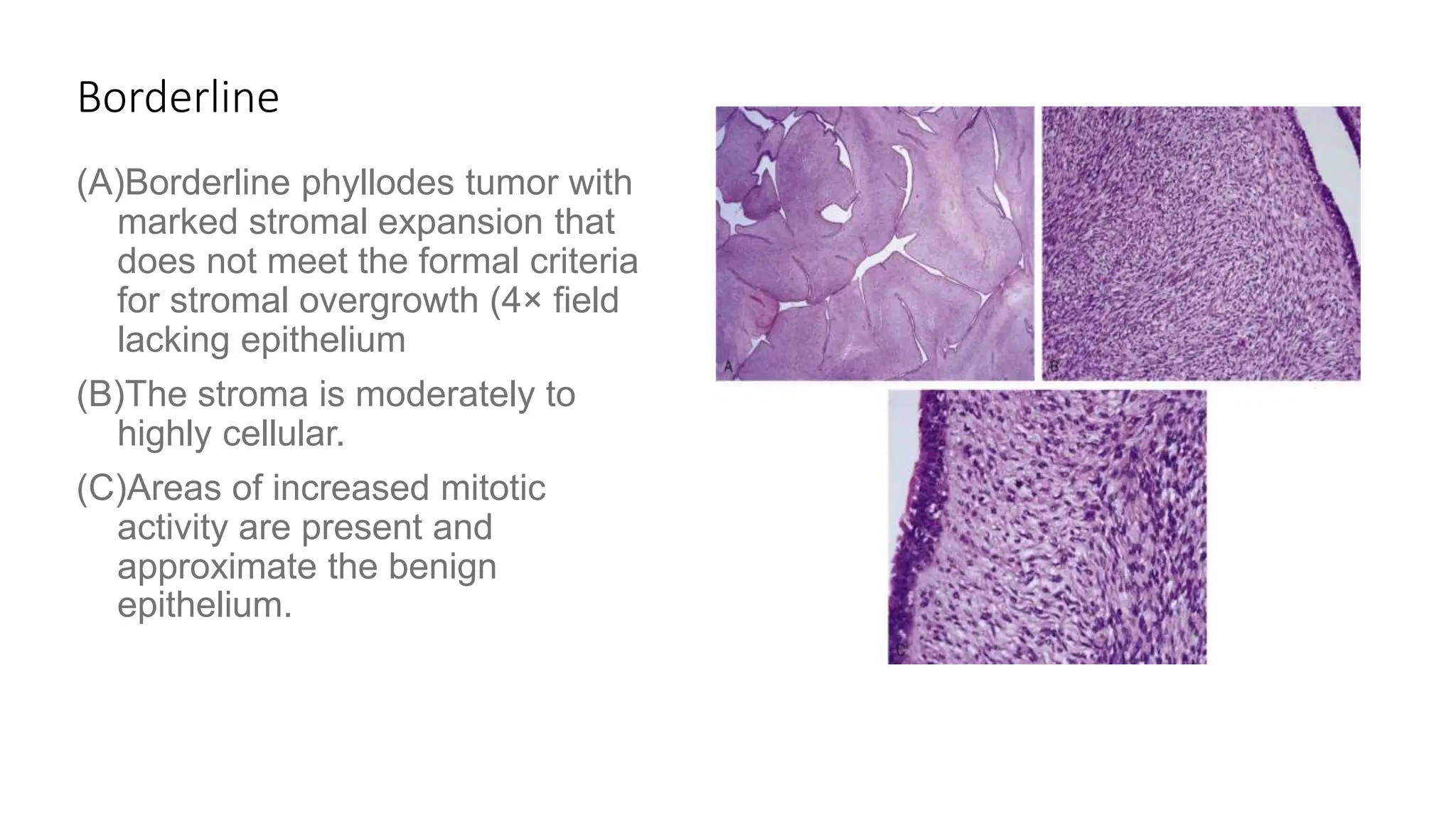 phyllodes tumour final presentation of breast | PPTX