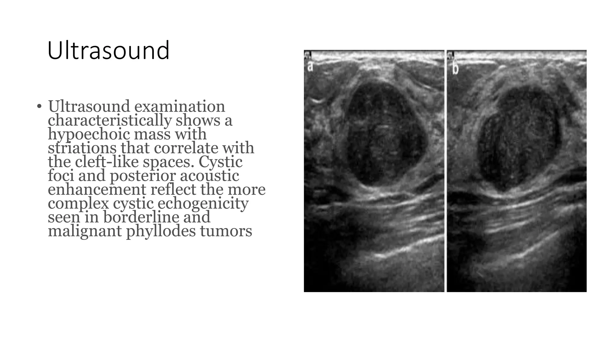 phyllodes tumour final presentation of breast | PPTX