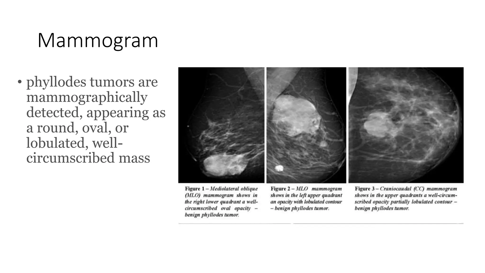 phyllodes tumour final presentation of breast | PPTX
