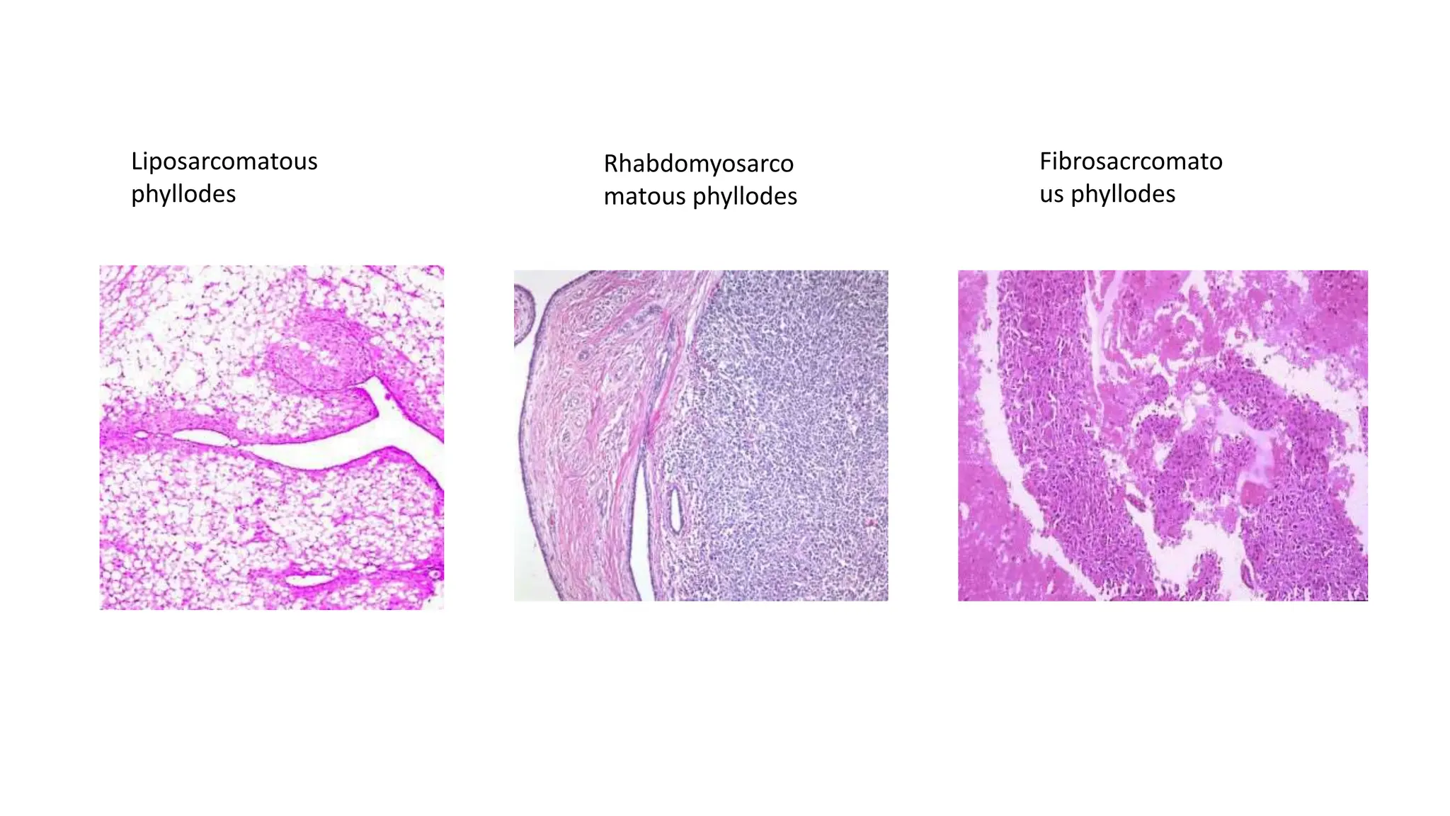 phyllodes tumour final presentation of breast | PPTX