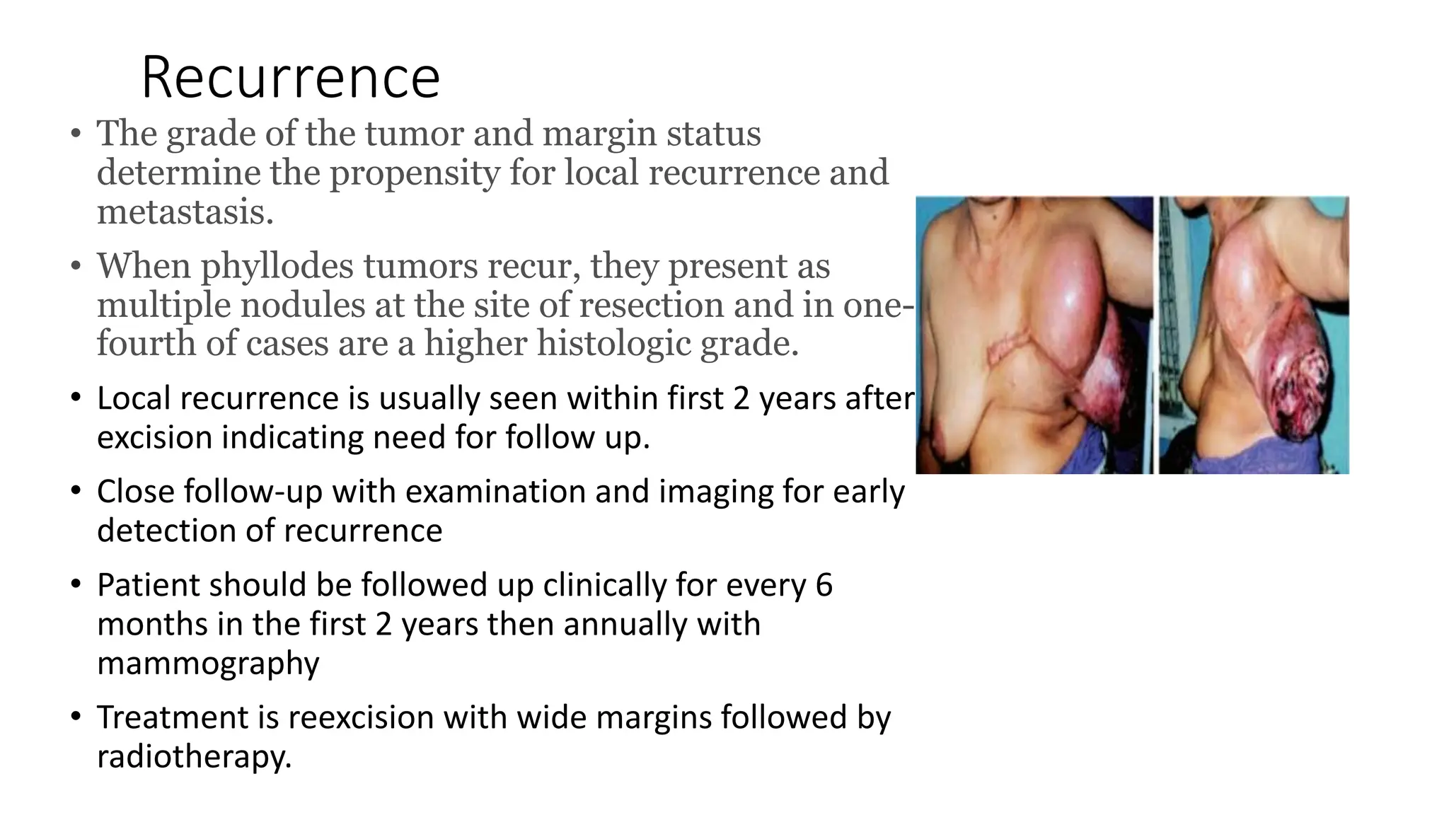 phyllodes tumour final presentation of breast | PPTX