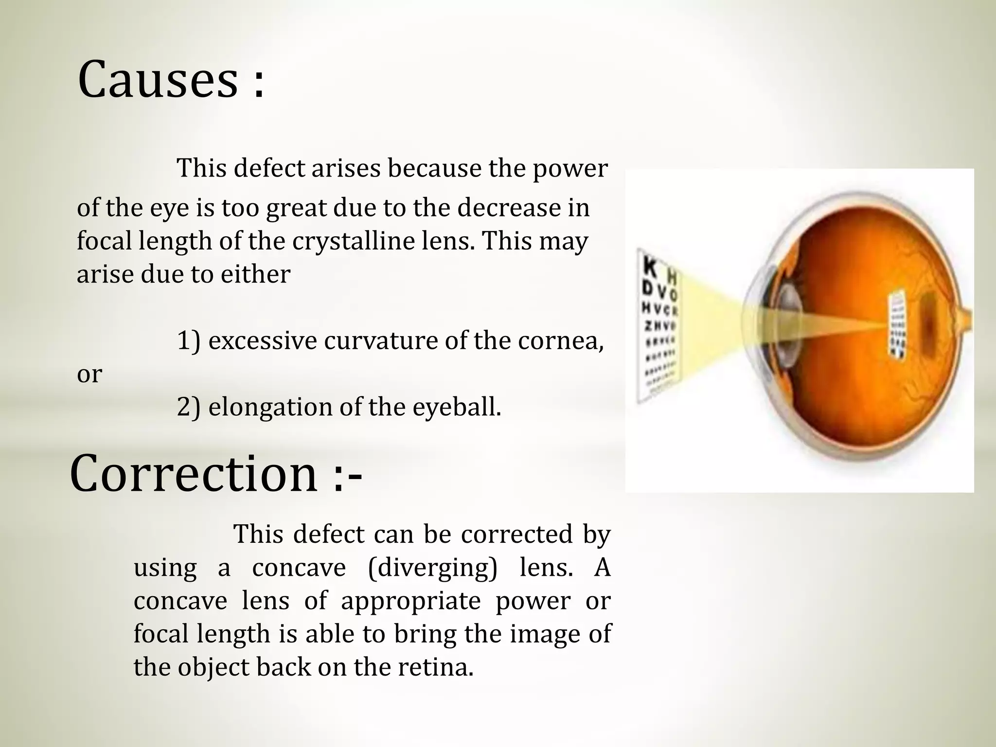 defects of eye class 10 phy | PPTX