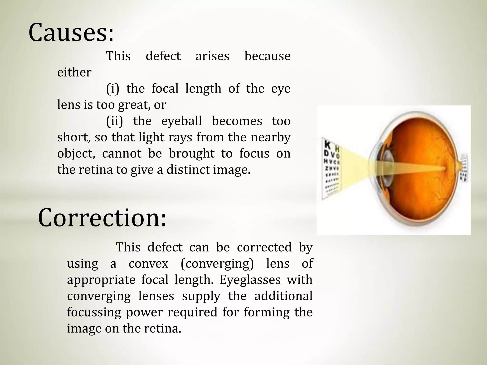 defects of eye class 10 phy | PPTX