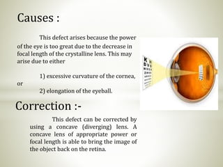 defects of eye class 10 phy | PPTX