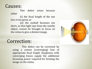 defects of eye class 10 phy | PPTX