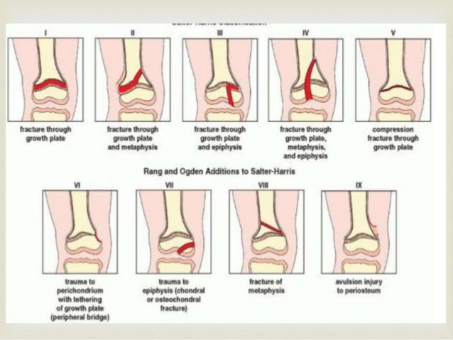 Physeal injuries