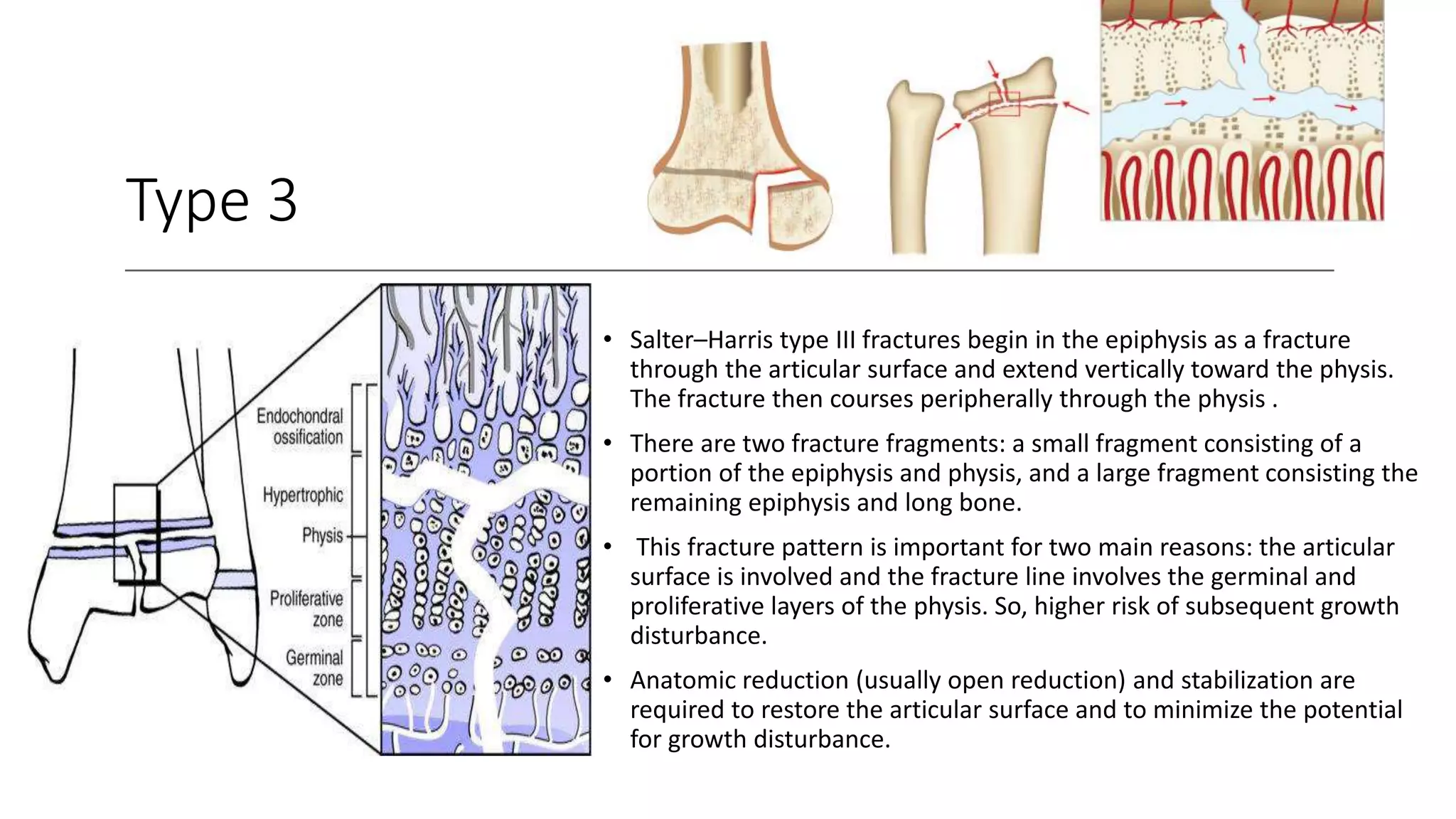 Physeal injuries | PPTX