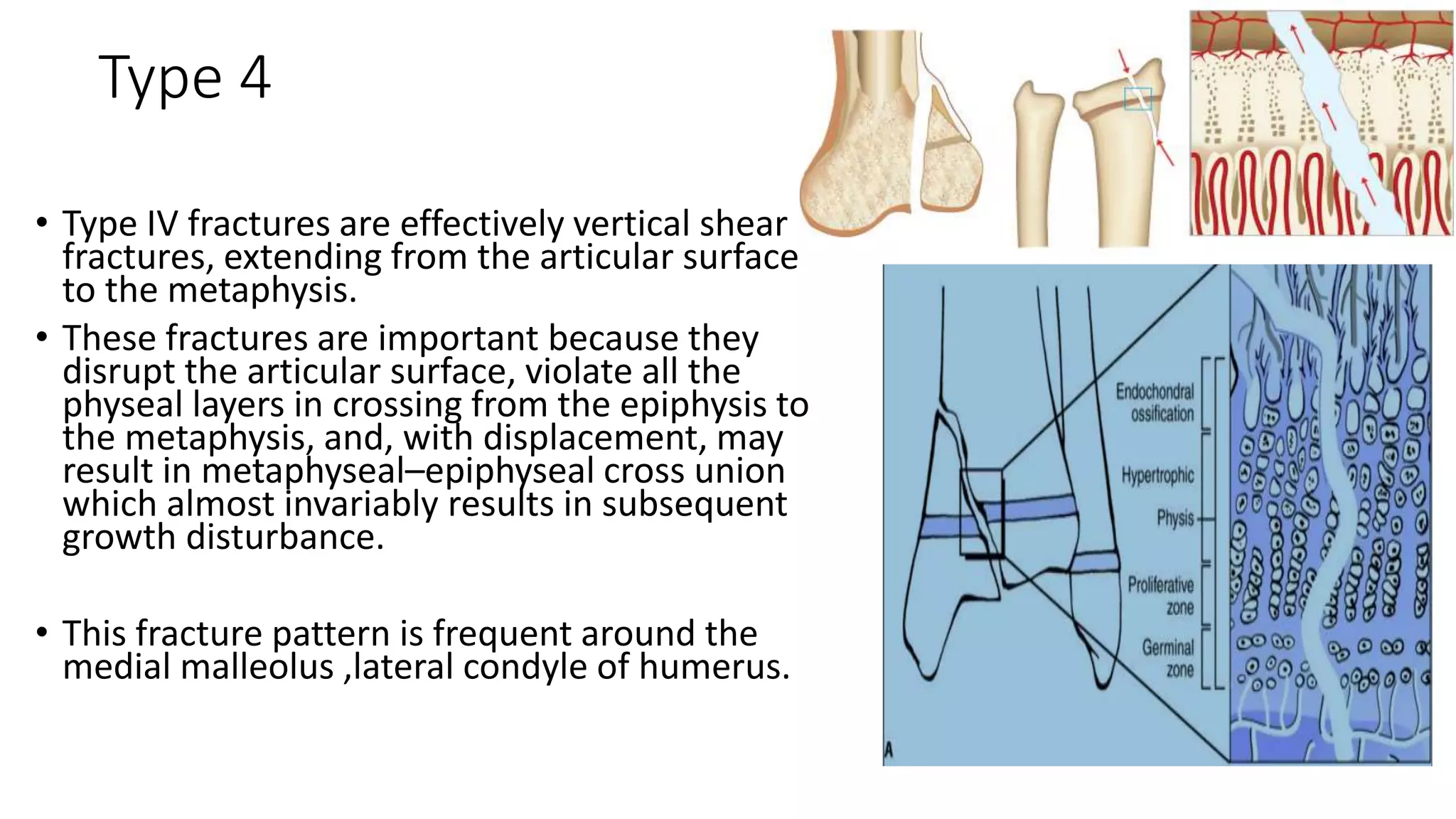Physeal injuries | PPTX