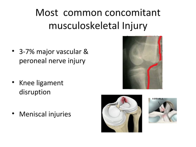 Physeal injury knee | PPT
