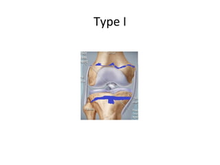 Physeal injury knee | PPT