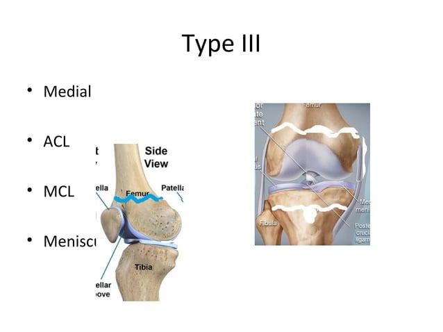 Physeal injury knee | PPT