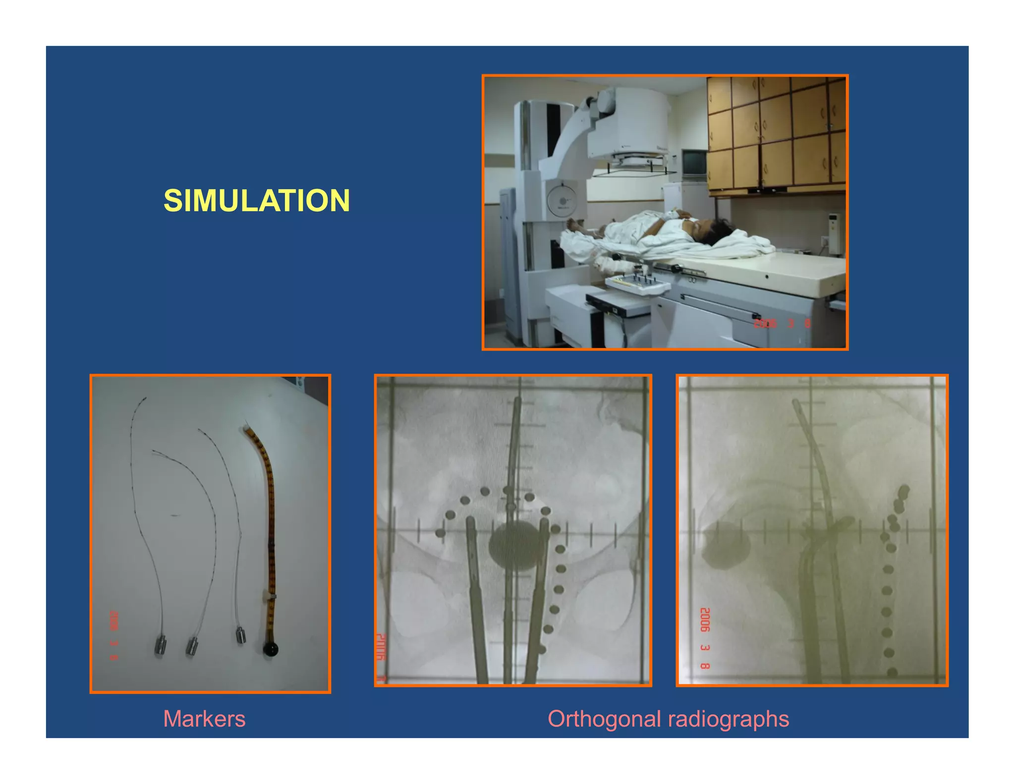 Physical and clinical aspects of brachytherapy | PDF