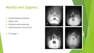 Imagine modalities in Maxillofacial trauma patients.pptx