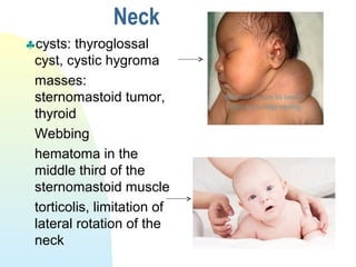 Webbed Neck Newborn