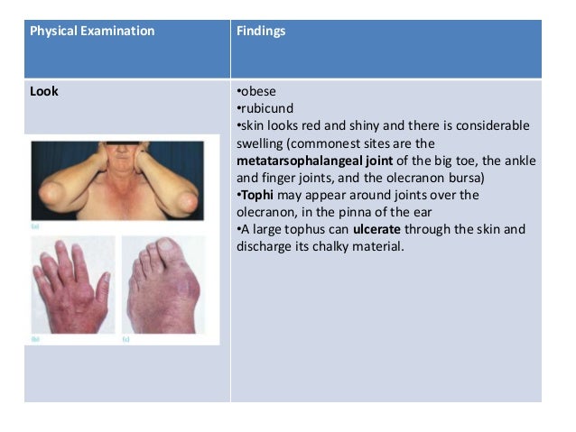 Physical examination for gout