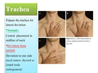 Tracheal Deviation Neck