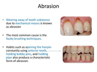 Physical injuries of teeth | PPTX