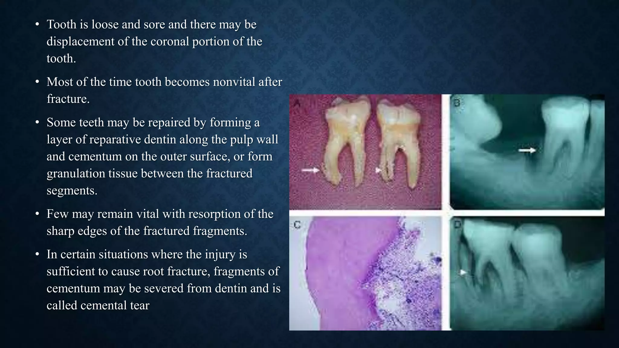 Physical injuries of teeth | PPTX