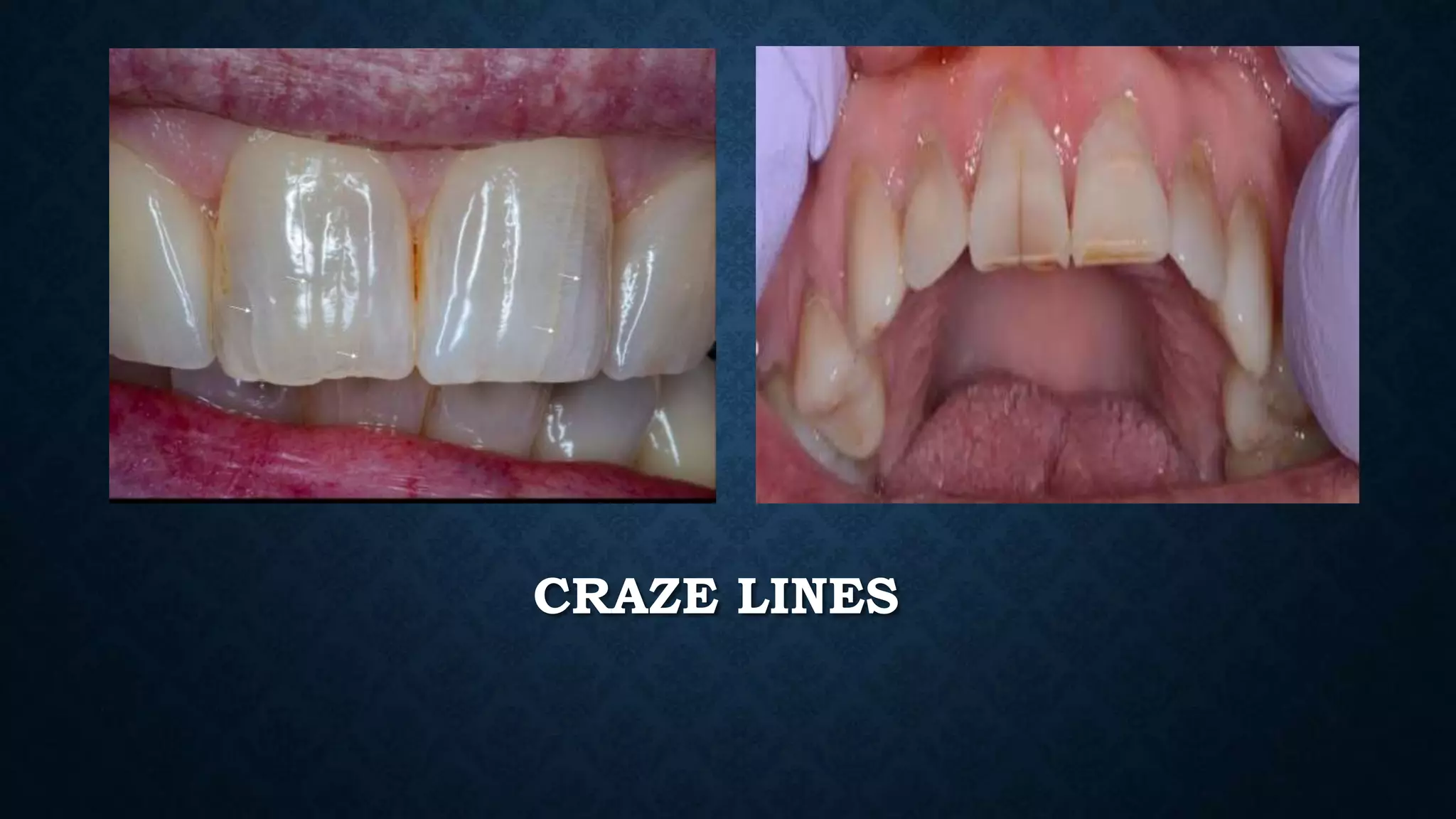 Physical injuries of teeth | PPTX