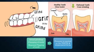 Physical injuries of teeth | PPTX
