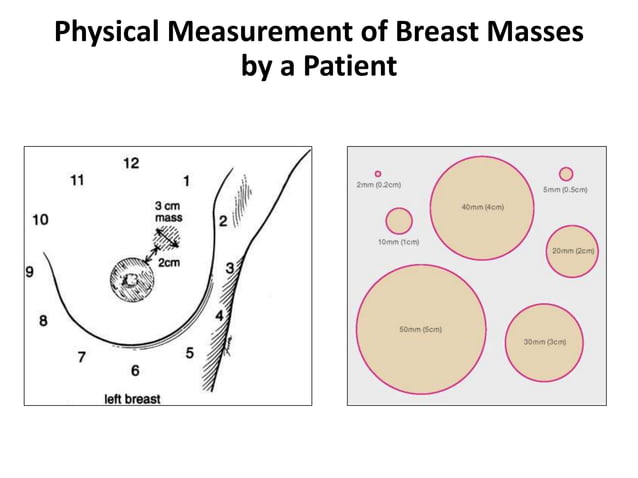 Physical measurement of breast masses | PPT