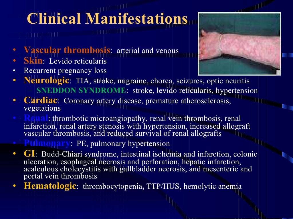A Case of Antiphospholipid Antibody Syndrome