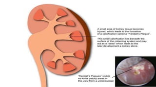 Physicochemistry of renal stones | PPTX