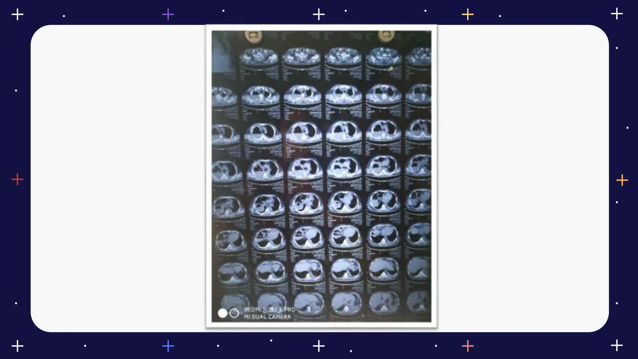 Polymicrobial lung abscess.pptx