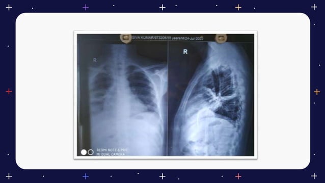 Polymicrobial lung abscess.pptx