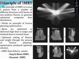 Intensity modulated radiation therapy and Image guided radiation ...