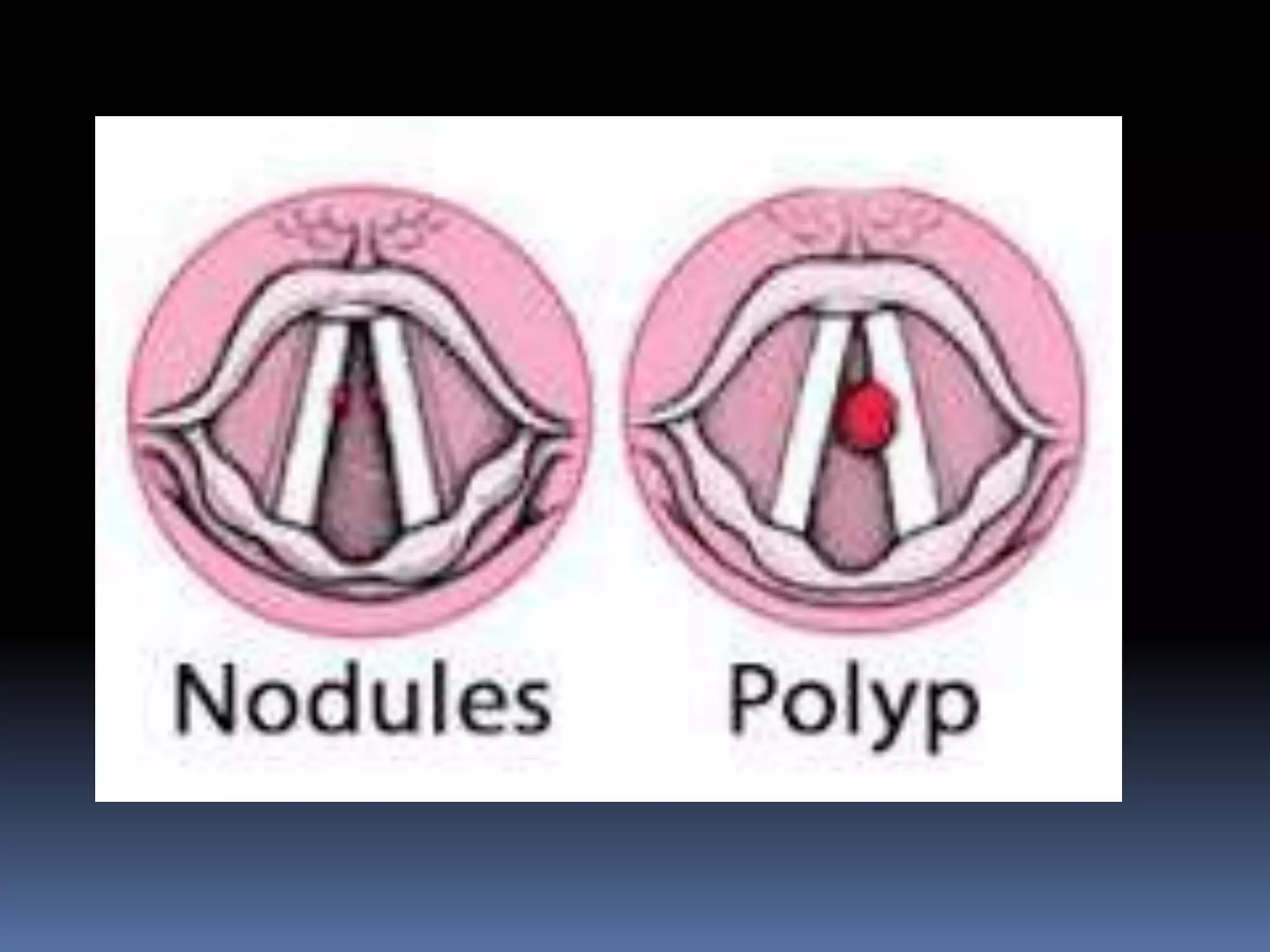 Physilogy of phonation by Dr.Ashwin Menon | PPTX
