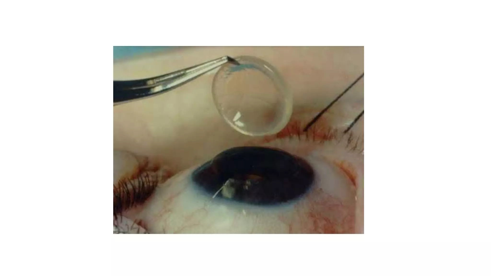 anatomy and physiology of layers of the eye | PPT